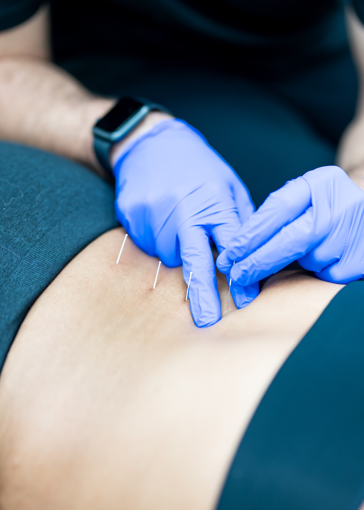 Transform Muscle Tension Relief with Dry Needling in Springfield